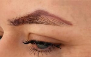 The details of the eyebrow laser tattoo removal process. - Elite Look
